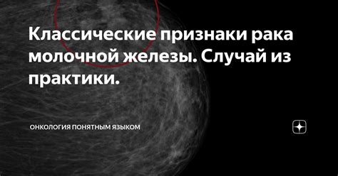 Классические признаки рака молочной железы Случай из практики Онкология понятным языком