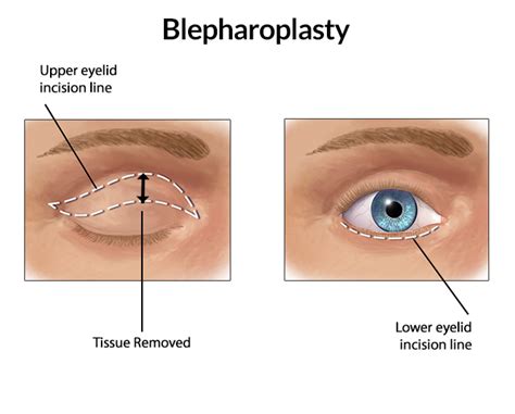 How To Fix Hooded Eyes 5 Surgical And Nonsurgical Procedures To Try