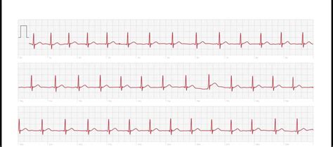 Dont Invest In Apple Watch To Track Afib To Many False Positive R