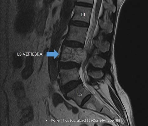 Ultimate Radiology Aggressive Malignant Hemangioma Of Vertebrae