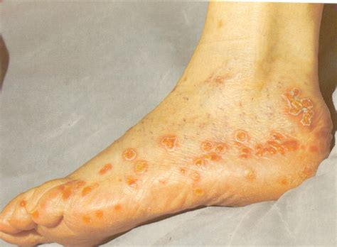 Keratoderma Blennorrhagicum