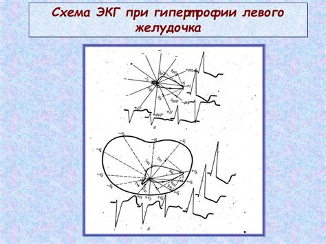 ЭКГ диагностика гипертрофии миокарда различных отделов сердца