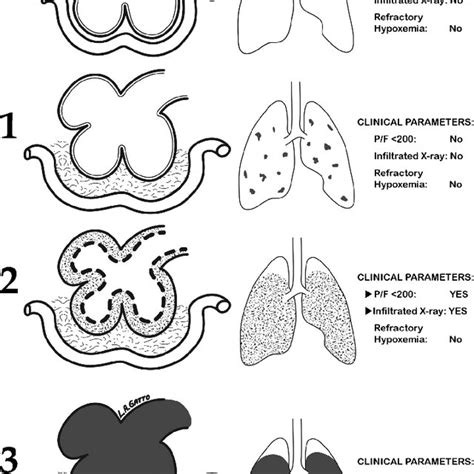 Hypothetical Staging Of Ards Onset Diagram Of Ards Development From