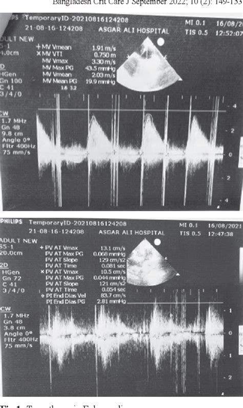 Figure 1 From Cardiac Ascites Presenting As Abdominal Compartment