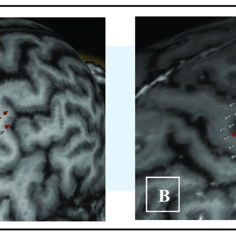 Example Of Variability Of Cortical Mapping Area Of The First Dorsal