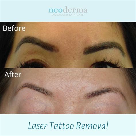Laser Tattoo Removal — Neoderma Advanced Skin Care