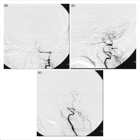 Anterolateral View A And Lateral View B Of Left Vertebral Artery