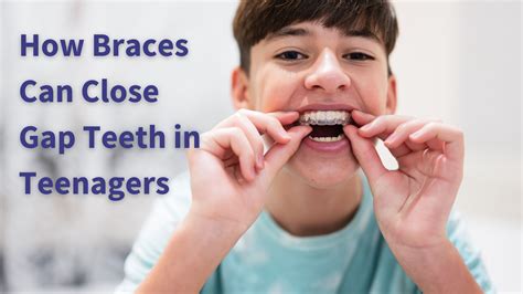 Braces For Gap Teeth In Teenagers Elite Orthodontics