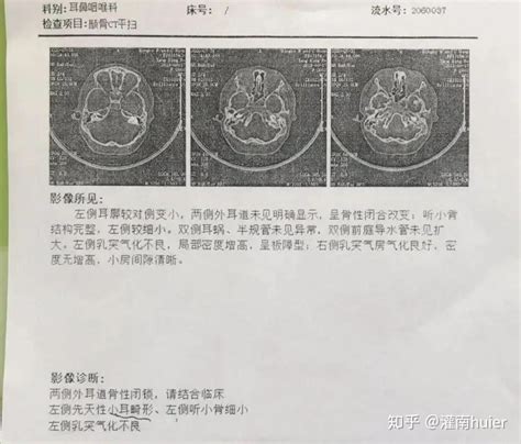 先天性小耳畸形听力干预or外耳整形 知乎