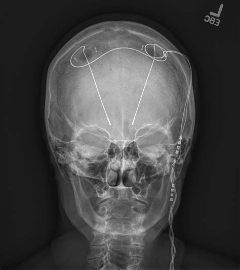 Twiddlers Syndrome In Deep Brain Stimulation Mds Abstracts