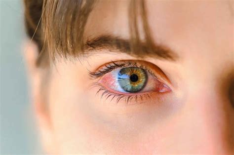 Red Eyes Causes Symptoms And When To See A Doctor Mia App Insights