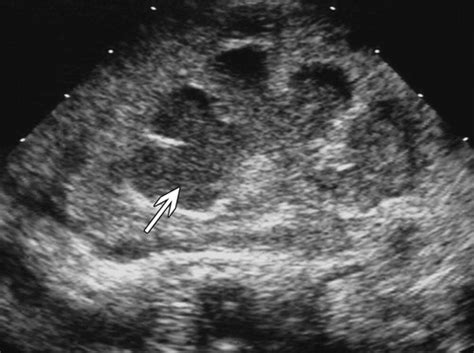 Xanthogranulomatous Pyelonephritis Radiology