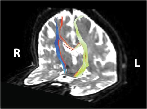 Corticomotor Fiber Tracts Ipsilesional Corticospinal Tract Shown In Download Scientific
