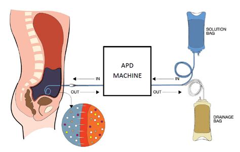 Australia Job Opportunity Best Home Dialysis Service Provider For