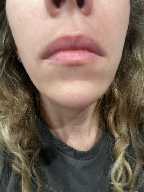 What To Do Bout Darkening Skin Above My Lip R30plusskincare