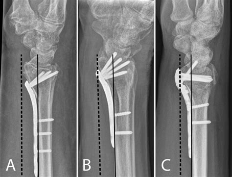 Lateral Radiographs Demonstrating Assessment Using The Soong