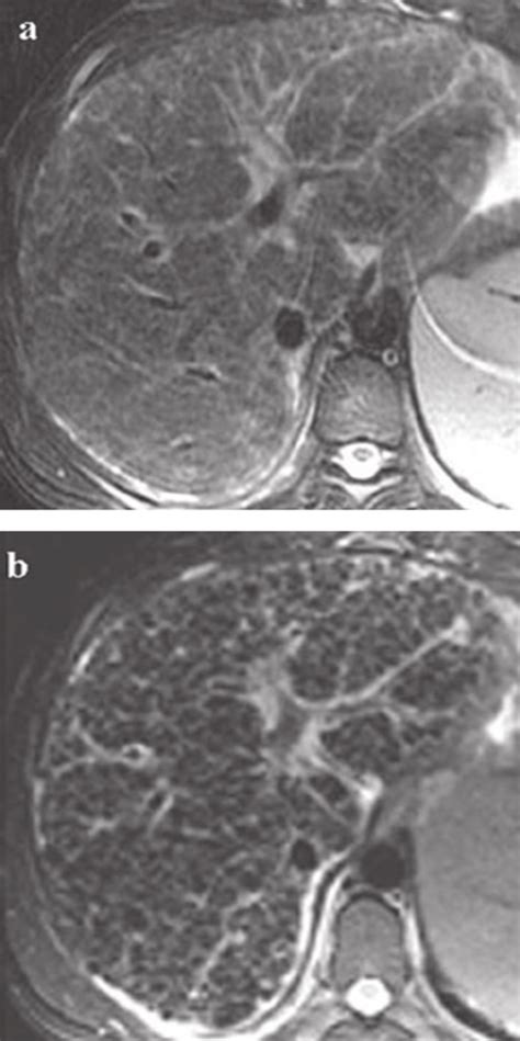 Cirrhotic Liver With Multiple Regenerative Nodules And Fibrotic Bands