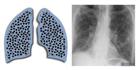 Chest X Ray