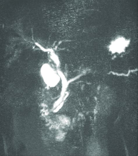 Choledocholithiasis Mrcp