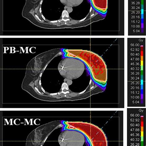 Dose Distributions In Pb Optimization Followed By Pb Dose Calculation