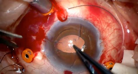 Iris Fixation Of An Iol With Mccannel Sutures Eyetube