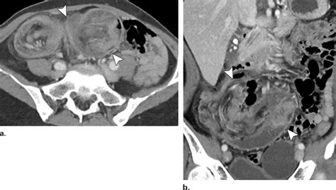 Ileo Colic Intussusception Resulting From A Cecal Adenocarcinoma In A