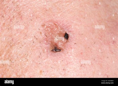 Basal Cell Carcinoma Bcc Or Rodent Ulcer On A 73 Year Old Mans