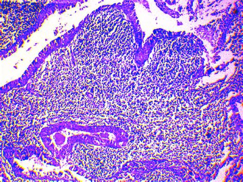 Warthins Tumor With Cystic Spaces Lined By Oncocytic Columnar And