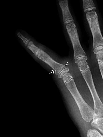 Salter Harris Type II Fracture Finger Radiology Case Radiopaedia Org