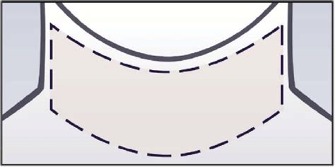 Assessment Guide For The Allergan Transverse Neck Lines Scale