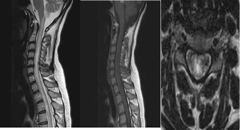 A Sagittal T2 B Sagittal T1 And C Axial T2 Of The Spine Show A