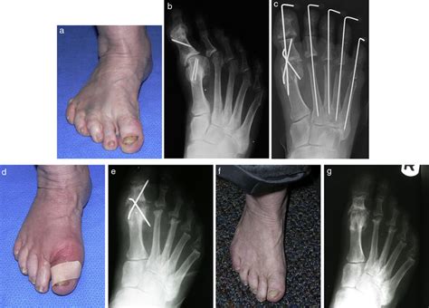 A And B Preoperative Appearance Of A Patient With Hallux Varus And