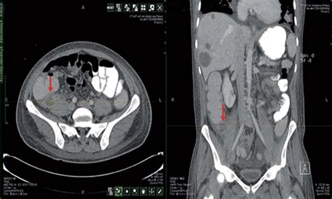 Computed Tomography Scan Of The Abdomen And Pelvis With Intravenous