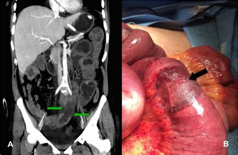 Mucormicosis Gastrointestinal