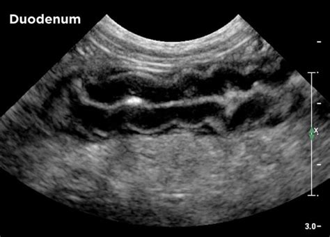 Abnormal Pancreas Ultrasound