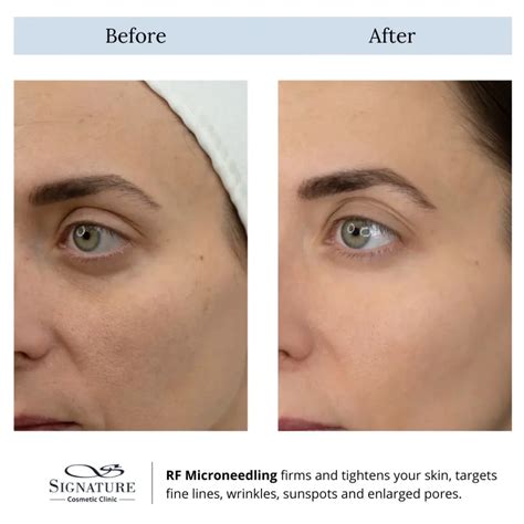Potenza Rf Microneedling Toronto Potenza Treatment Signature