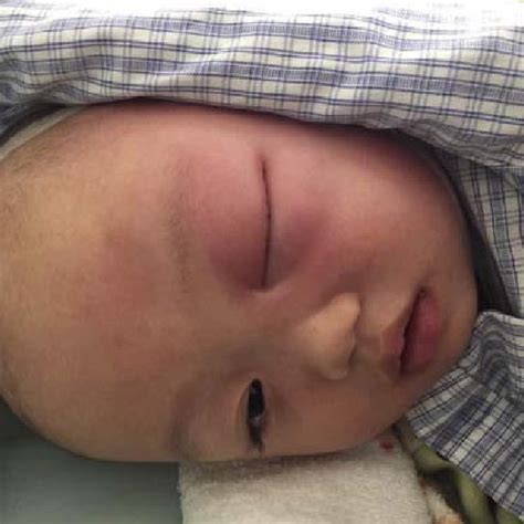 Cervical Soft Tissue Swelling And Interstitial Exudation Spreading To