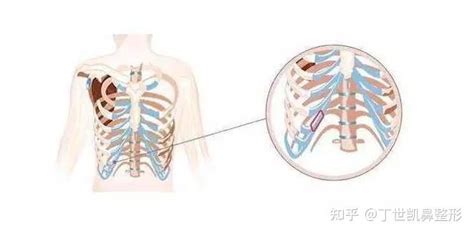 肋软骨隆鼻是最好的吗？ 知乎