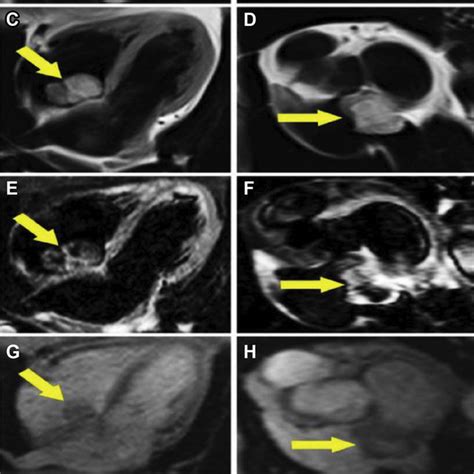 Cardiac Magnetic Resonance Download Scientific Diagram
