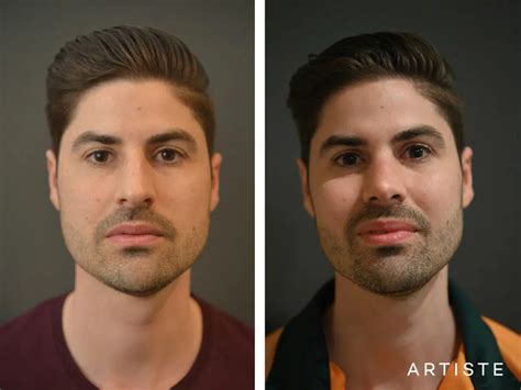 Male Rhinoplasty Gallery Artiste Plastic Surgery
