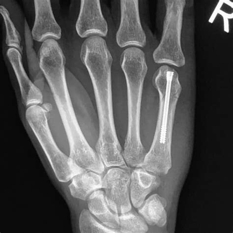 Dr Marco A Guadarrama Gutierrez Fractura Del Boxeador O Del 5to
