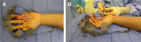 Tenolysis And Salvage Procedures Hand Clinics