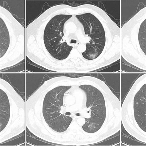 Blur Nodules In The Dorsal Segment Of The Lower Lobe Of The Left Lung Download Scientific