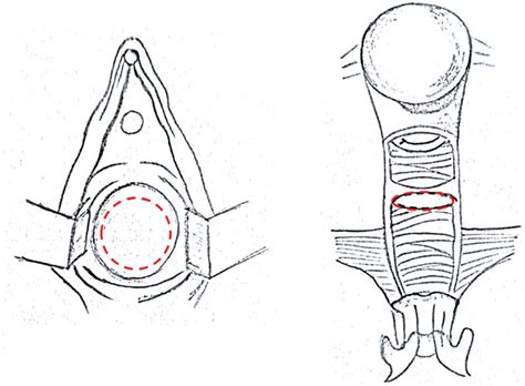 Drawings Of The Hysteroscopic Resection The Red Circle Indicates The