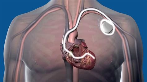 What Is Cardiac Resynchronization Therapy Crt And How Does It Work