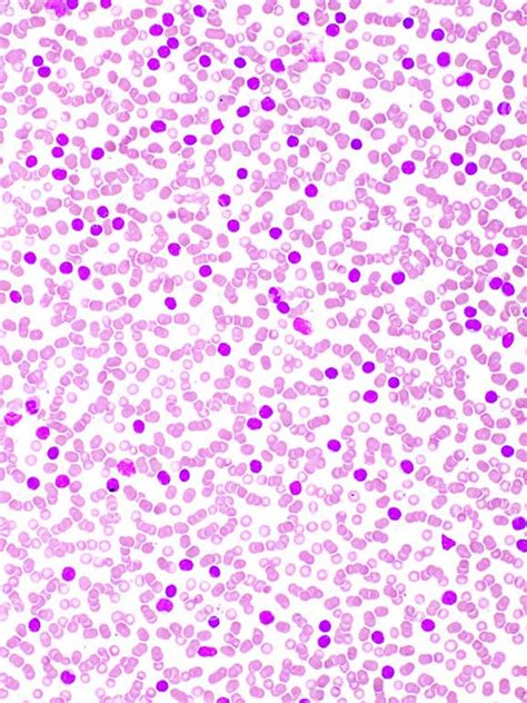 Imagem De Leucemia Linfocítica Aguda Ou De Células Lla No Sangue Foto