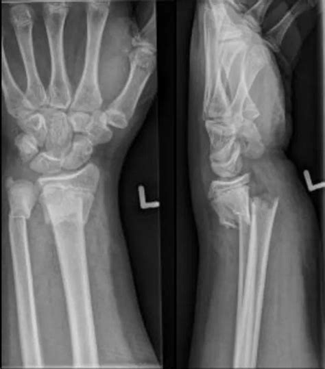 Crush Fracture Radiology At Hayden Champ Blog