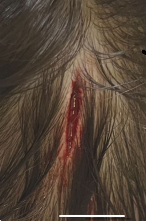 보건실이야기 처치 두피 열상 응급처치 네이버 블로그