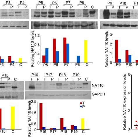 Pdf Nat10 Is Upregulated In Hepatocellular Carcinoma And Enhances