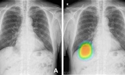 Lung Cancer High Accuracy AI Improves Detection Healthcare In Europe Com